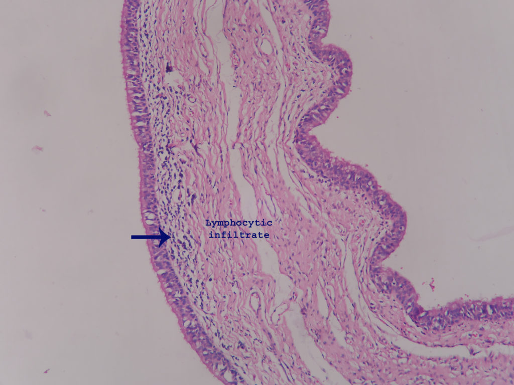 Branchial Cleft Cyst Histopathologyguru