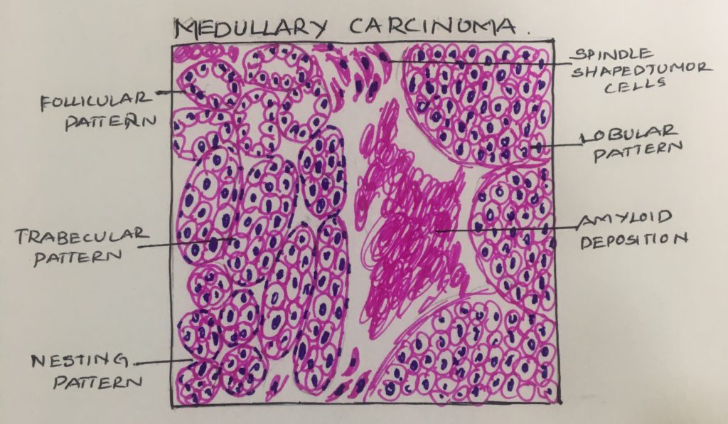 Medullary Carcinoma Thyroid UG Histopathology guru Medullary Carcinoma Thyroid UG Histopathology guru