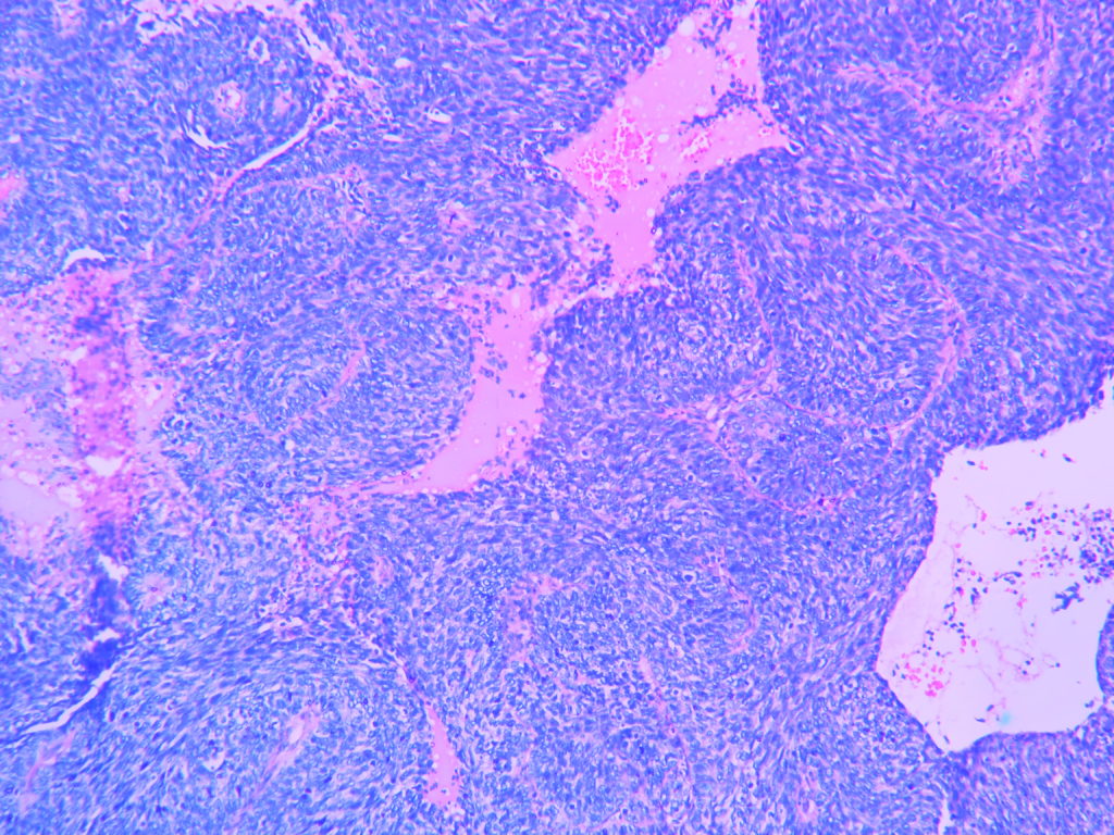 Basaloid Squamous Cell Carcinoma Histopathology Guru