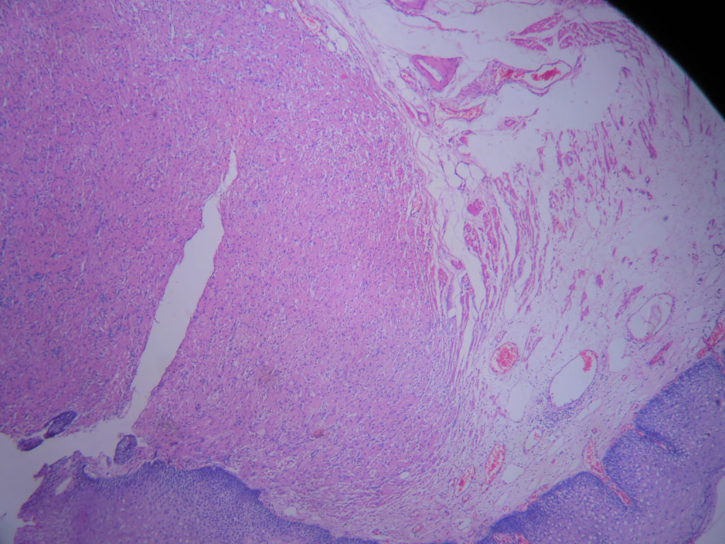 Granular Cell Tumor Esophagus Histopathology Guru