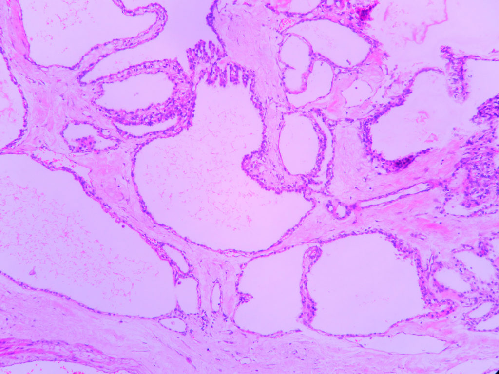 Serous Cystadenoma Of Pancreas Histopathology Guru