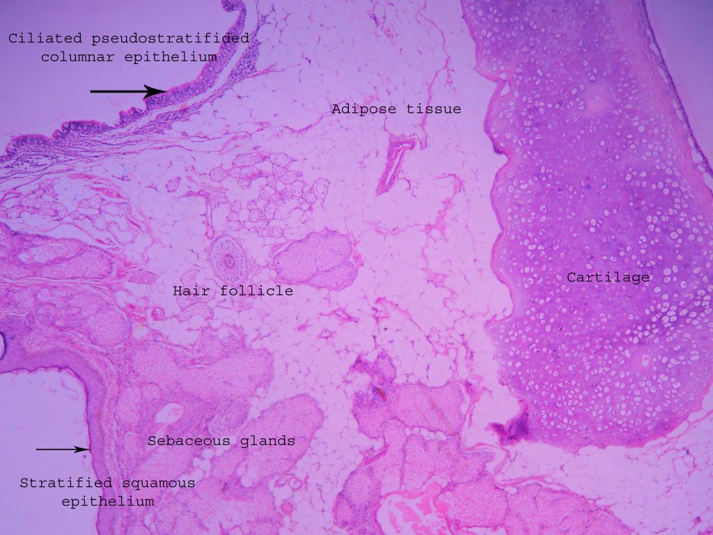Dermoid Cyst Ovary Histopathology Guru