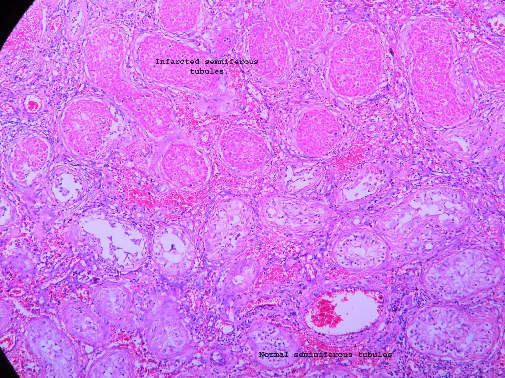 Coagulative Necrosis Infarction Testis Histopathology Guru