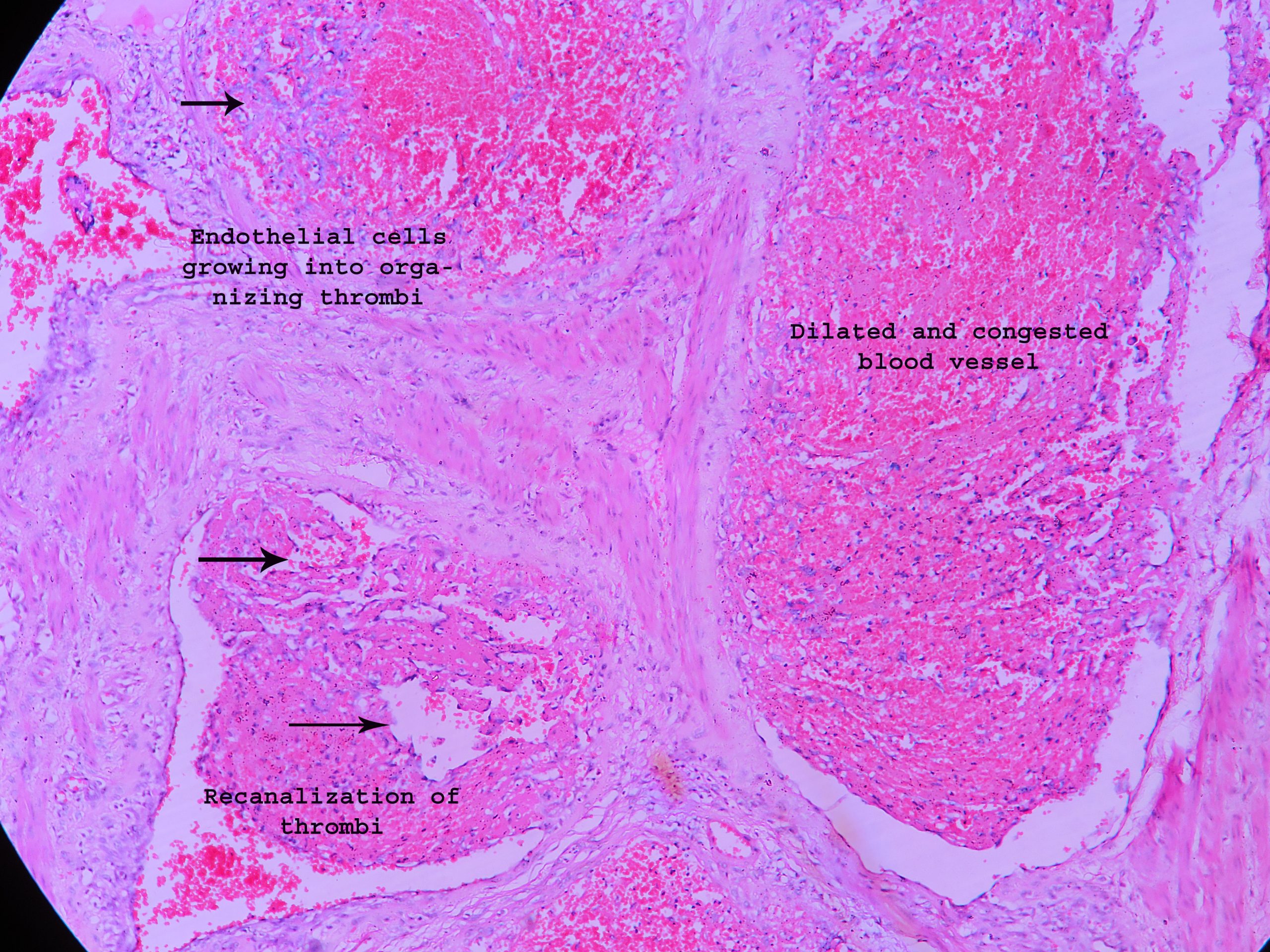 Organizing Thrombi Histopathology guru Organizing Thrombi Histopathology guru