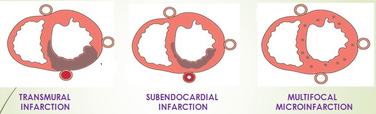 Myocardial Infarction Histopathology Guru