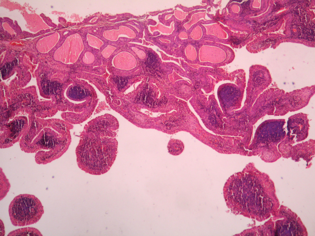Warthins tumor – Histopathology.guru