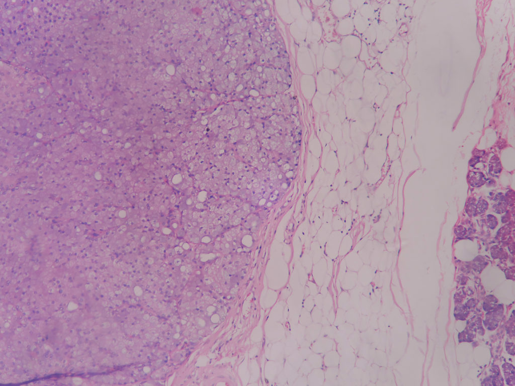 Acinic cell carcinoma – Histopathology.guru