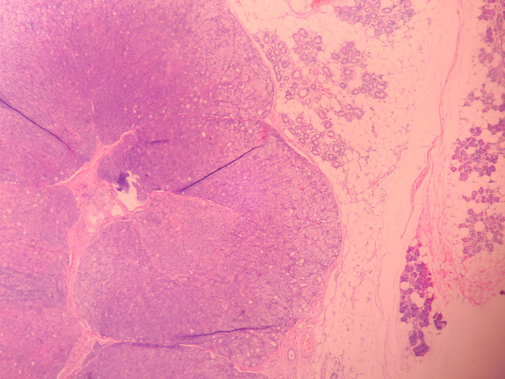Acinic cell carcinoma – Histopathology.guru