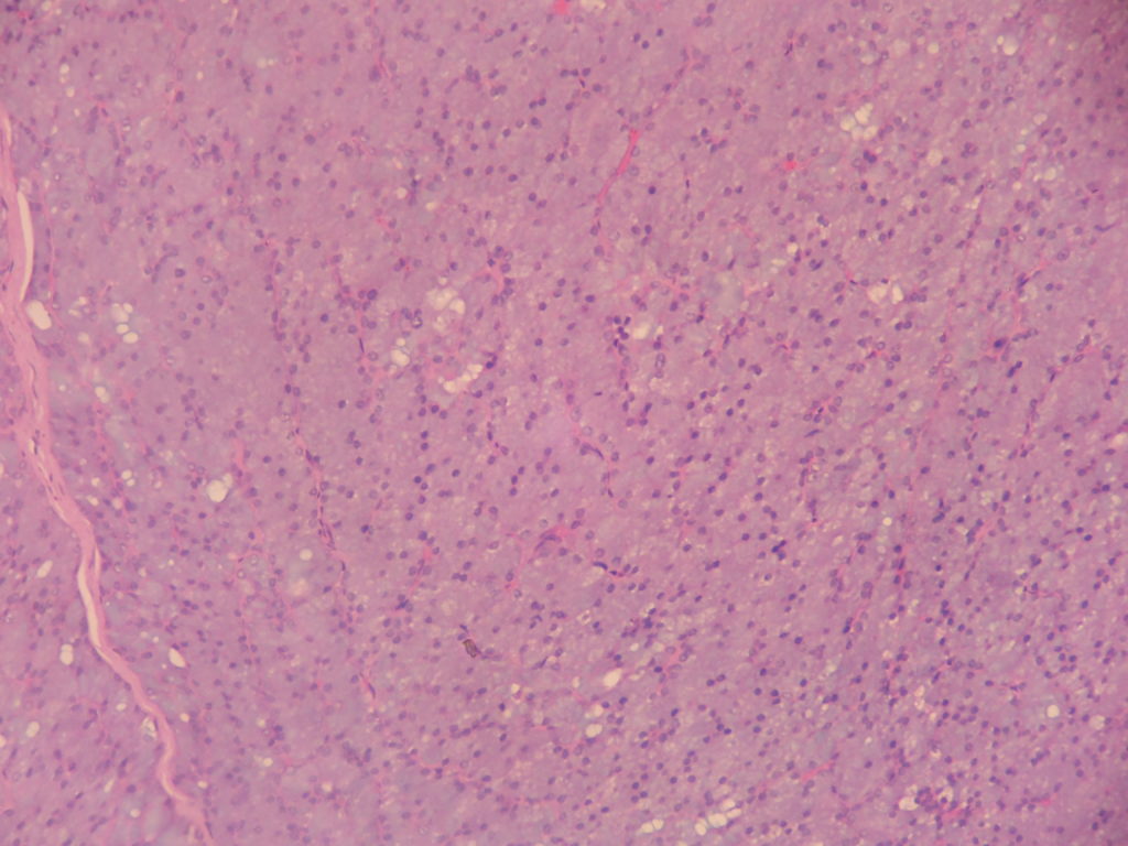 Acinic cell carcinoma – Histopathology.guru
