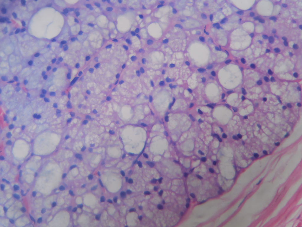 Acinic cell carcinoma – Histopathology.guru