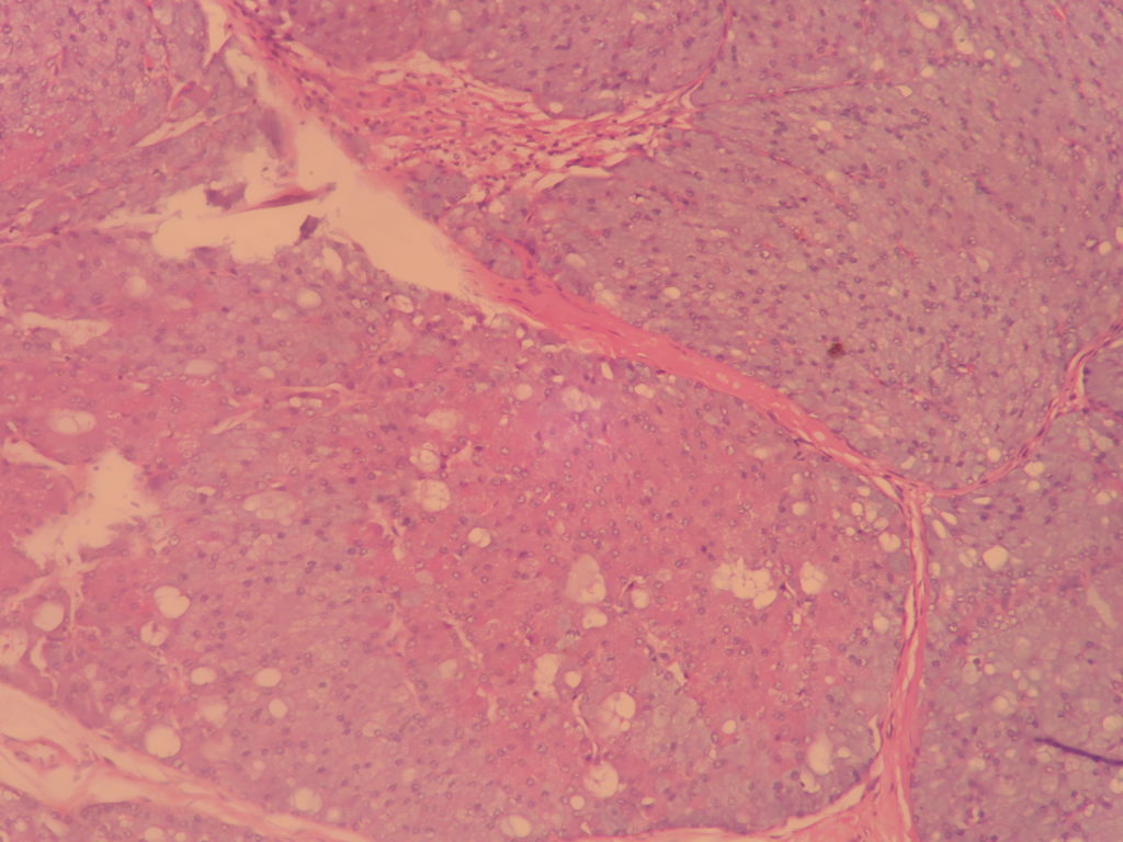 Acinic cell carcinoma – Histopathology.guru