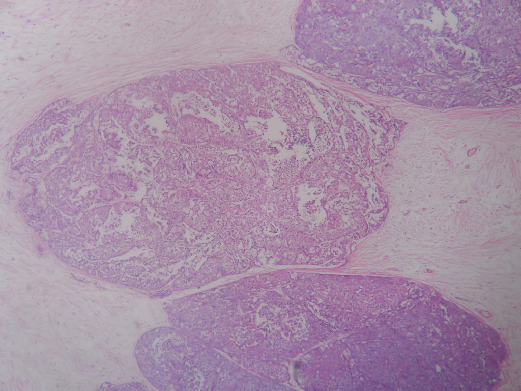 Acinic cell carcinoma – Histopathology.guru
