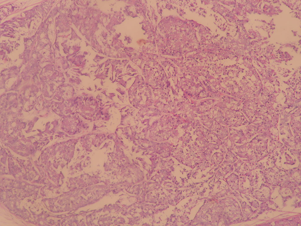Acinic cell carcinoma – Histopathology.guru