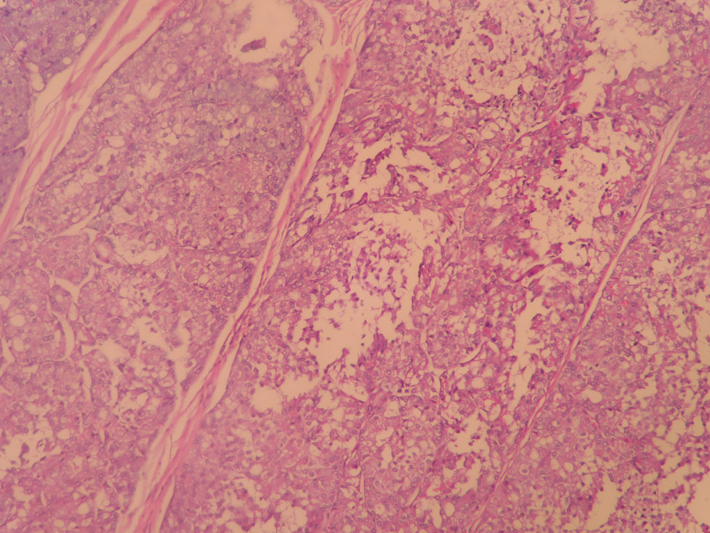Acinic cell carcinoma – Histopathology.guru
