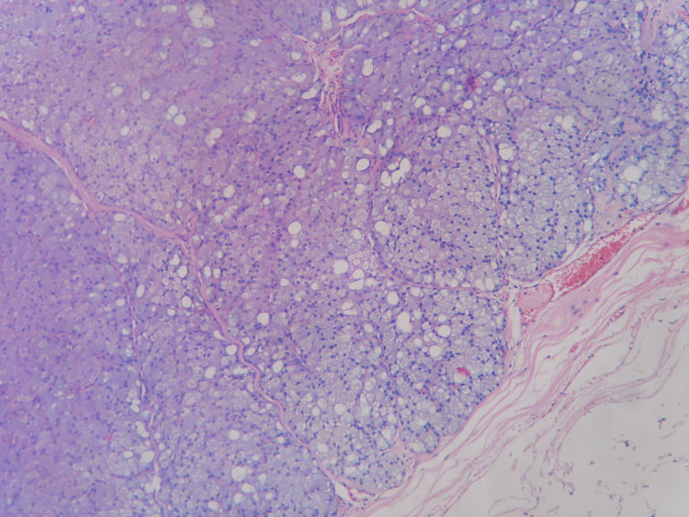 Acinic cell carcinoma – Histopathology.guru