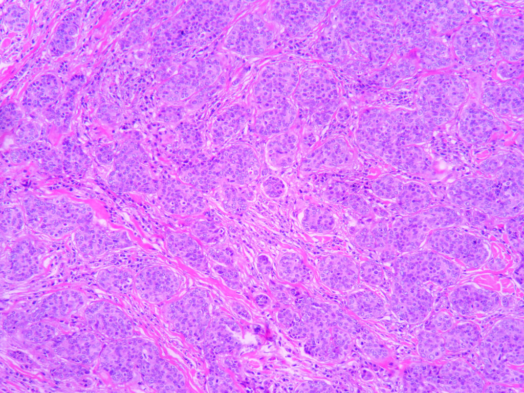 Adenocarcinoma NOS – Histopathology.guru