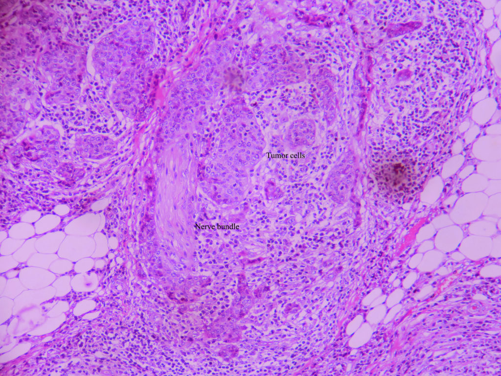 Adenocarcinoma NOS – Histopathology.guru