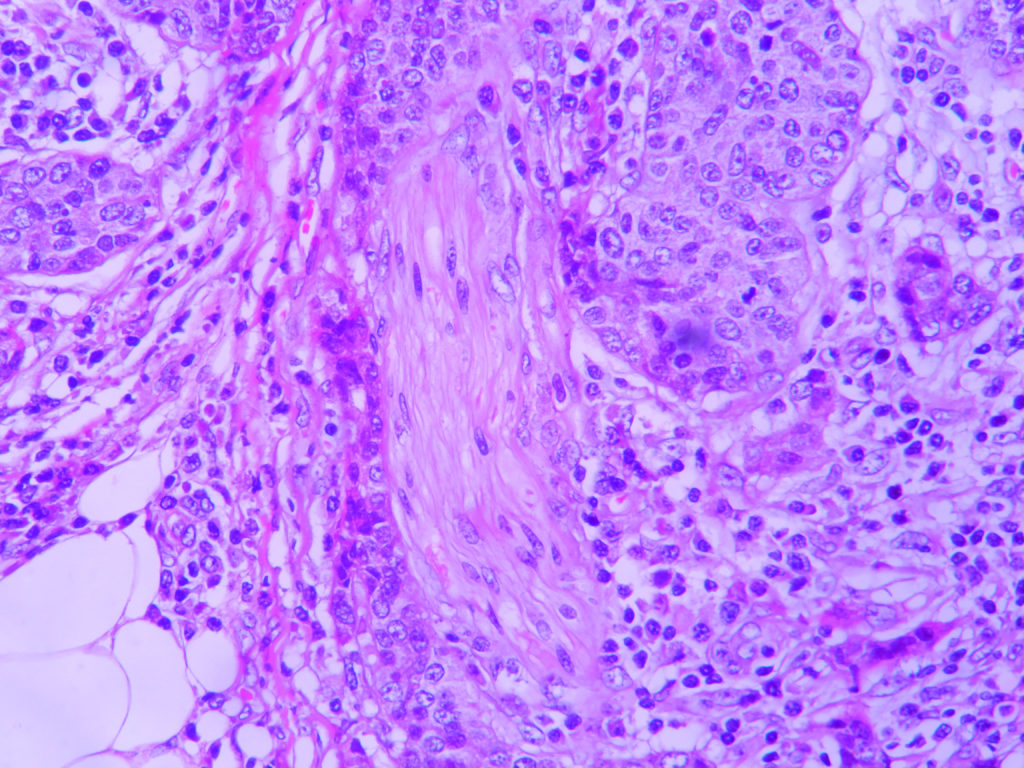 Adenocarcinoma NOS – Histopathology.guru