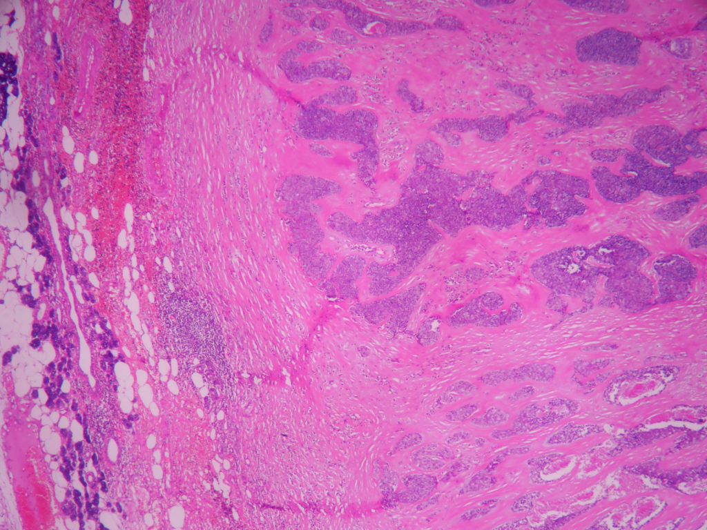 Adenocarcinoma NOS – Histopathology.guru