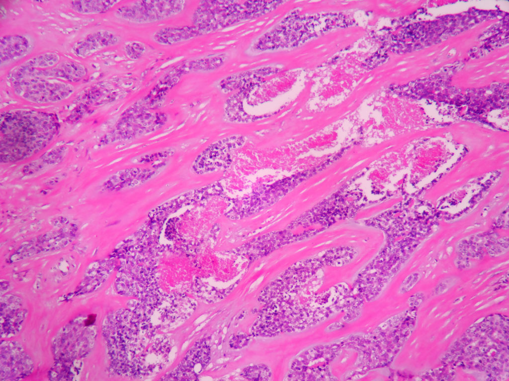 Adenocarcinoma NOS – Histopathology.guru