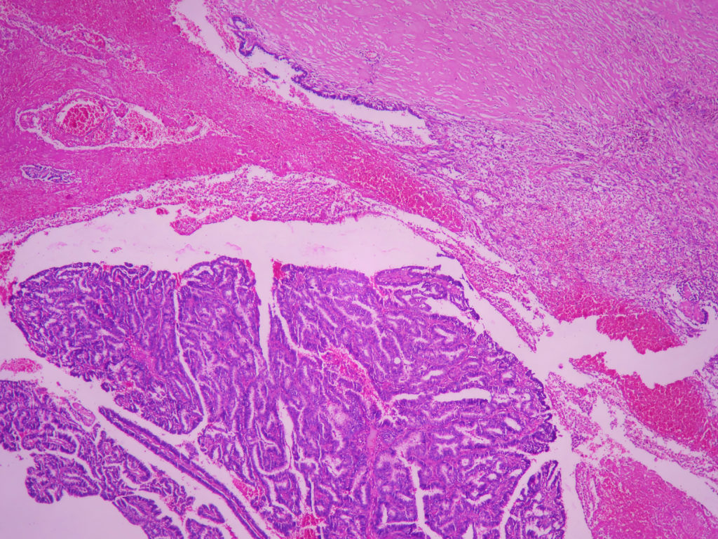 Intraductal papillary carcinoma – Histopathology.guru