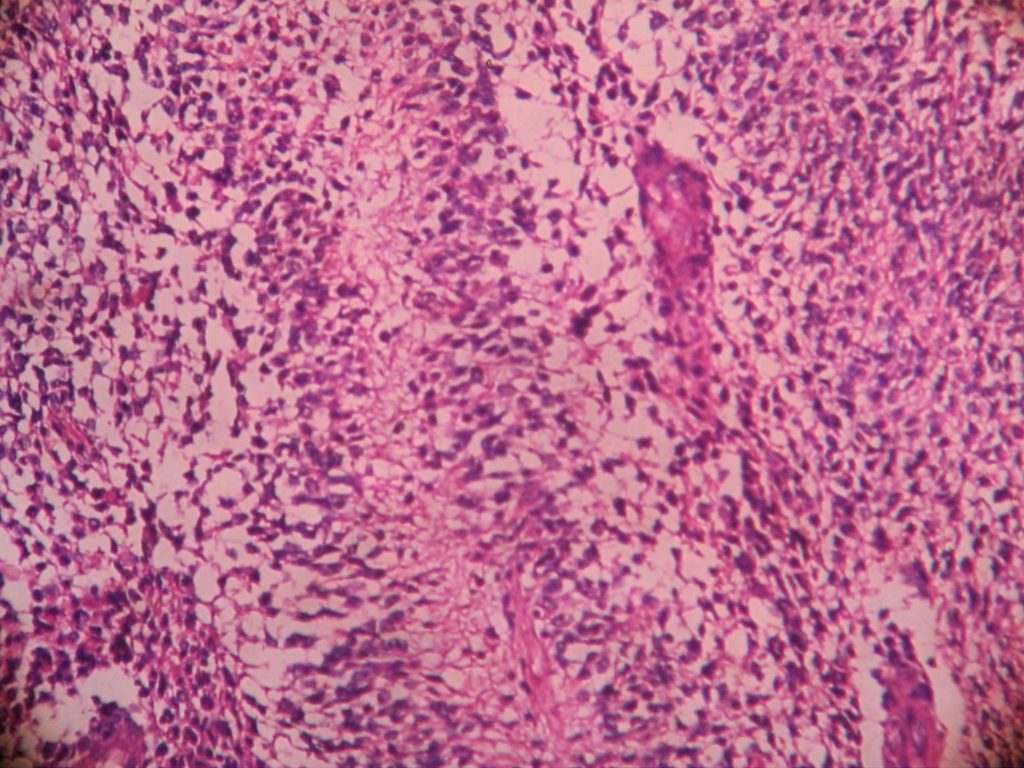 GLIOBLASTOMA – Histopathology.guru