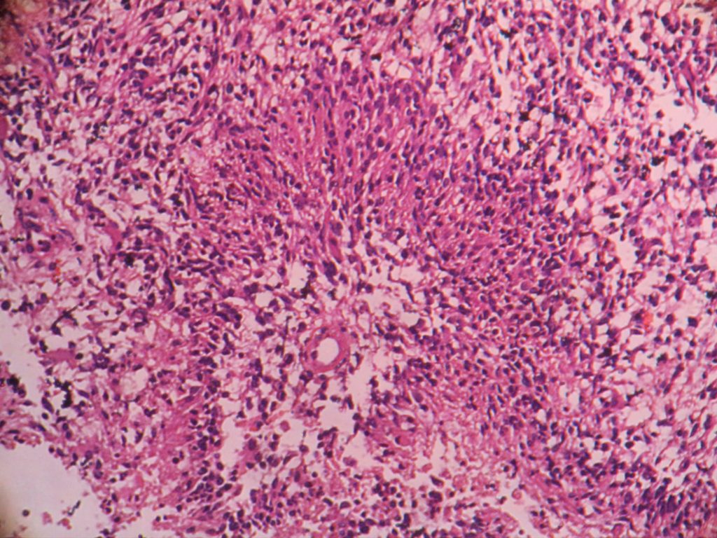 GLIOBLASTOMA – Histopathology.guru