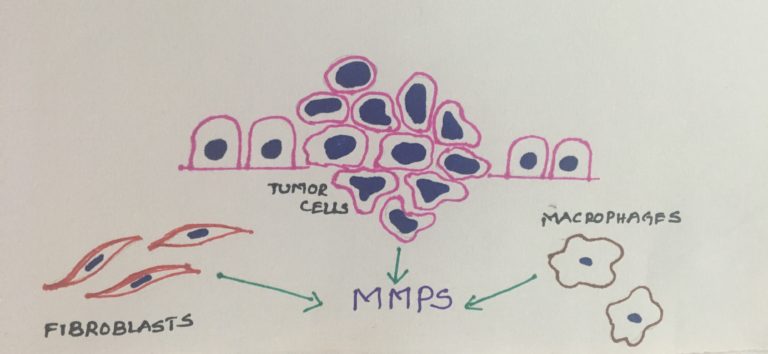 Haematogenous route of metastasis – Histopathology.guru