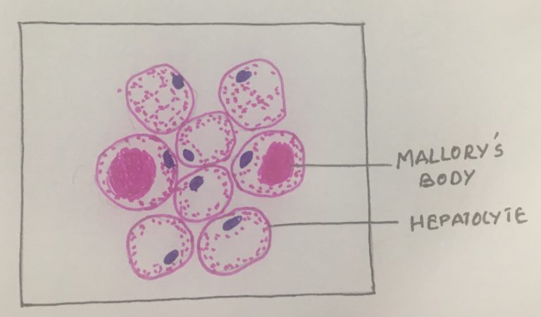 Mallory Hyaline – Histopathology.guru