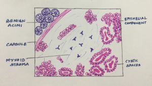 Pleomorphic adenoma – Histopathology.guru