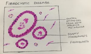 Fibrocystic disease breast. – Histopathology.guru