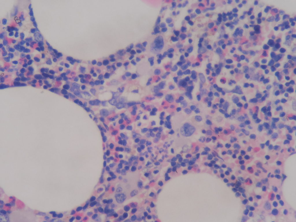 Adrenal myelolipoma – Histopathology.guru