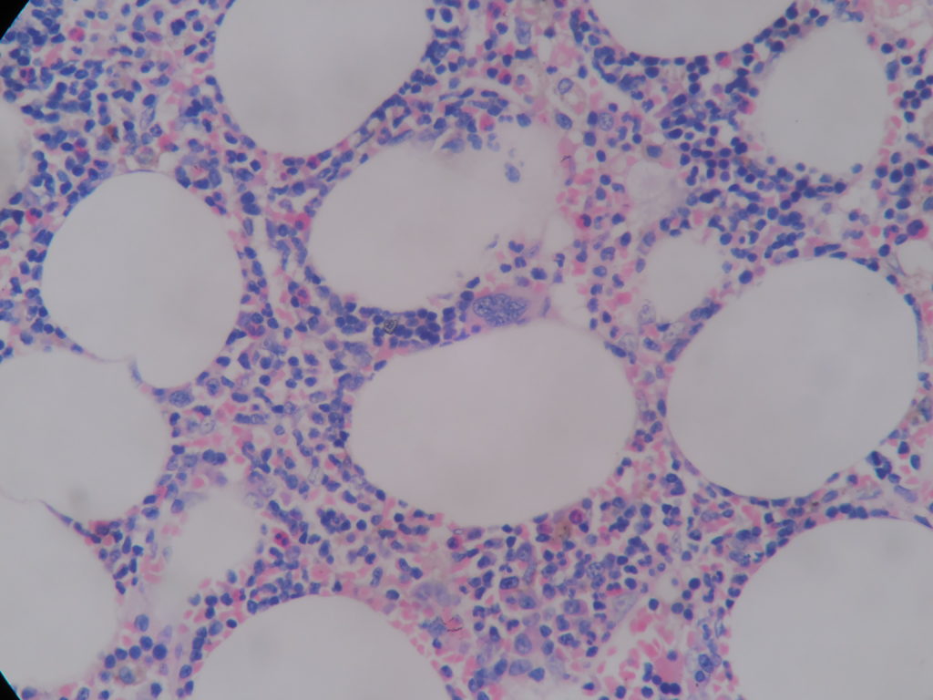 Adrenal myelolipoma – Histopathology.guru