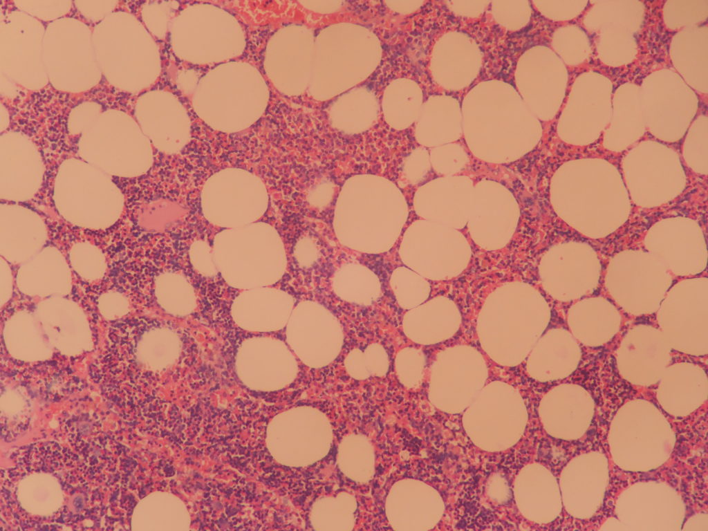 Adrenal myelolipoma – Histopathology.guru