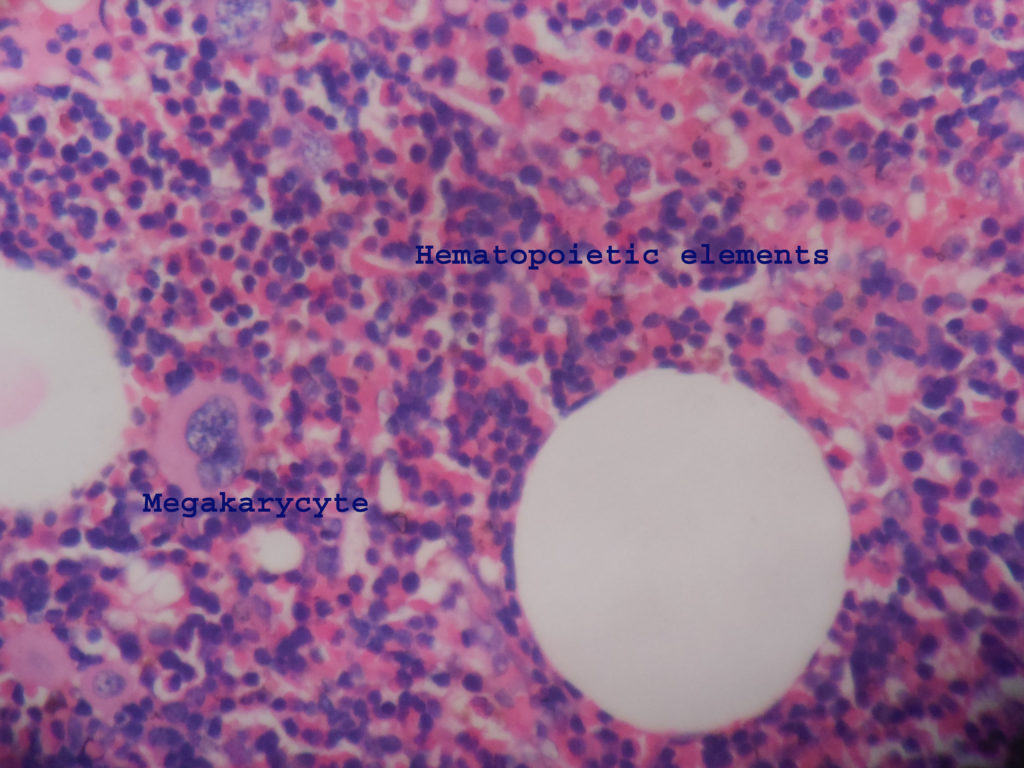 Adrenal myelolipoma – Histopathology.guru