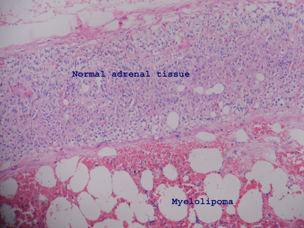 Adrenal myelolipoma – Histopathology.guru