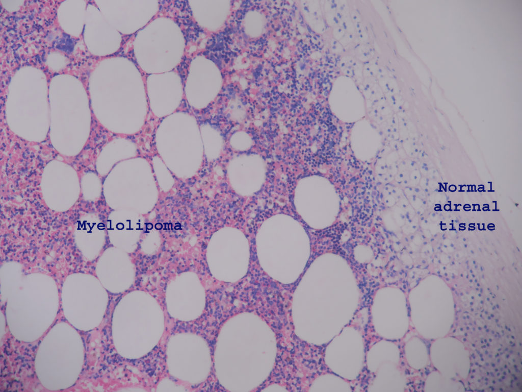 Adrenal myelolipoma – Histopathology.guru