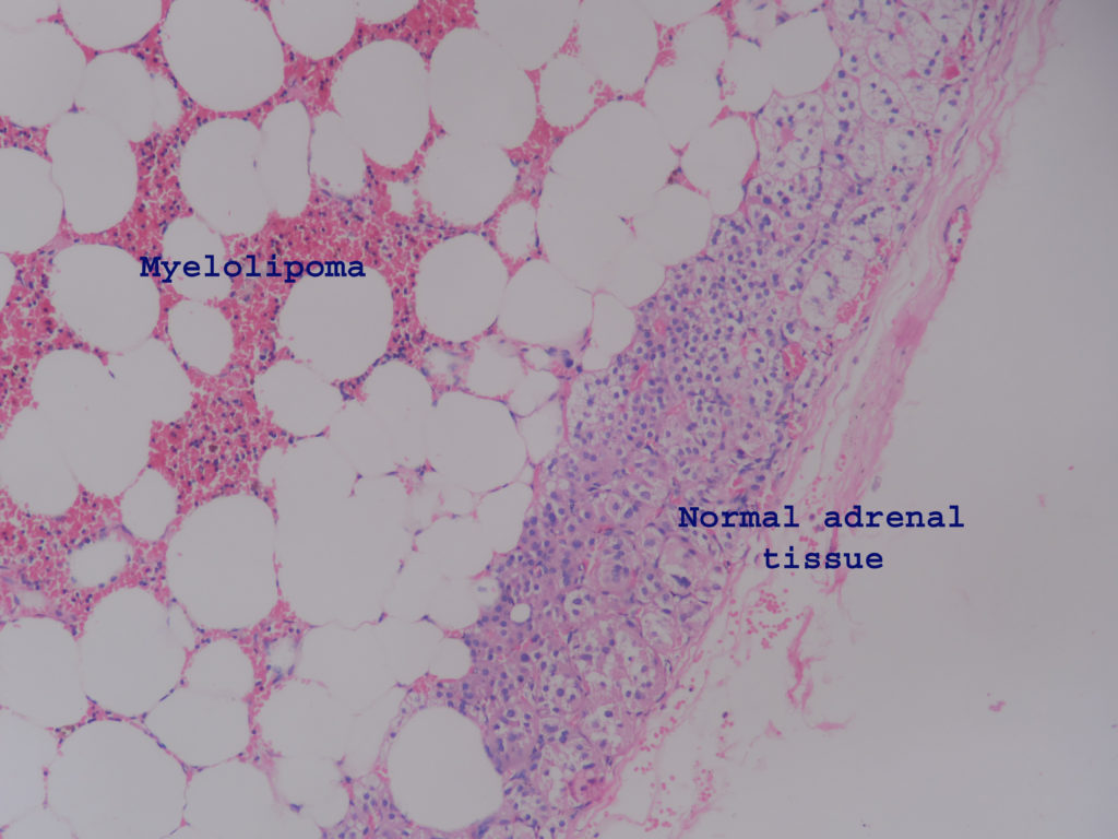 Adrenal myelolipoma – Histopathology.guru