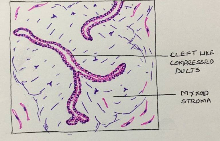 Diagramatic representation of two patterns of fibroadenoma ...