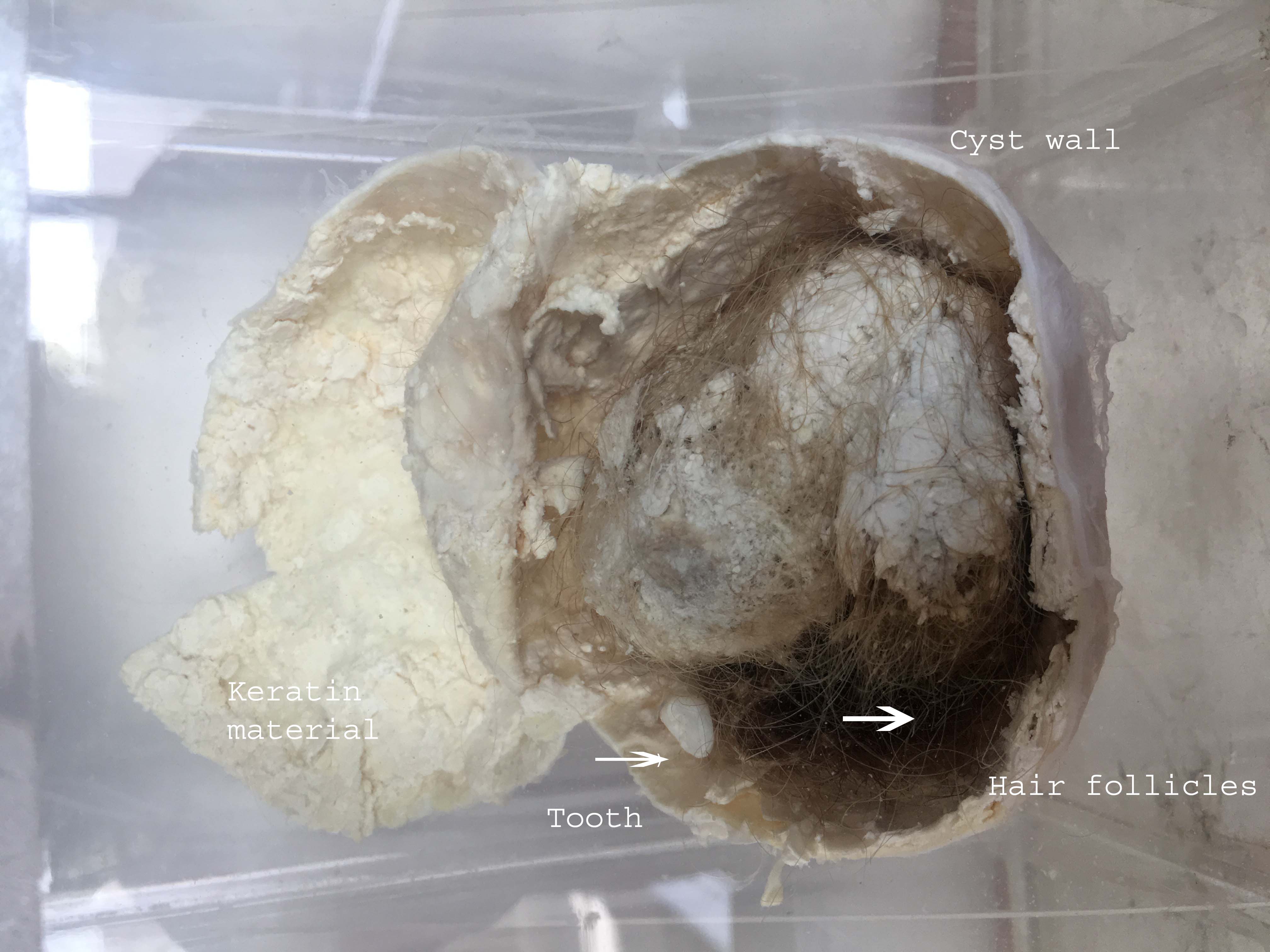 Dermoid Cyst Of Ovary Gross Histopathology guru Dermoid Cyst Of Ovary Gross Histopathology guru