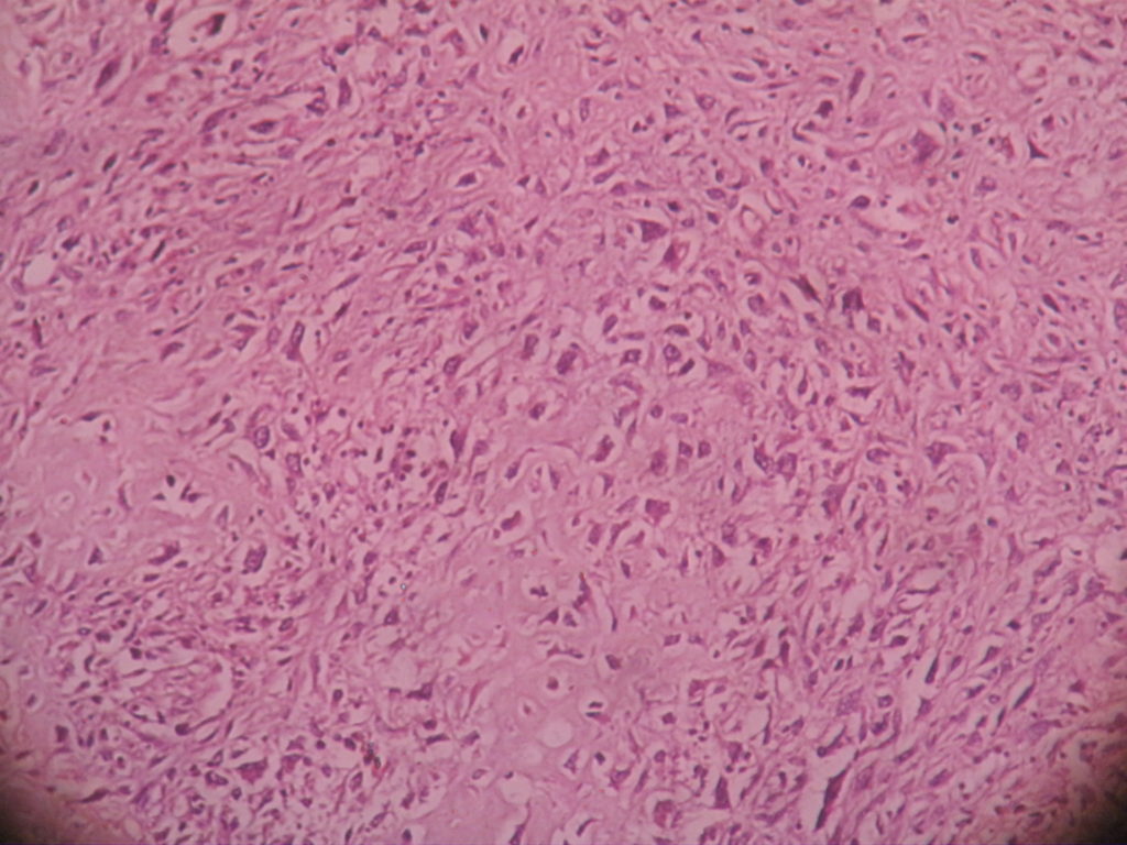 CHONDROSARCOMA – Histopathology.guru