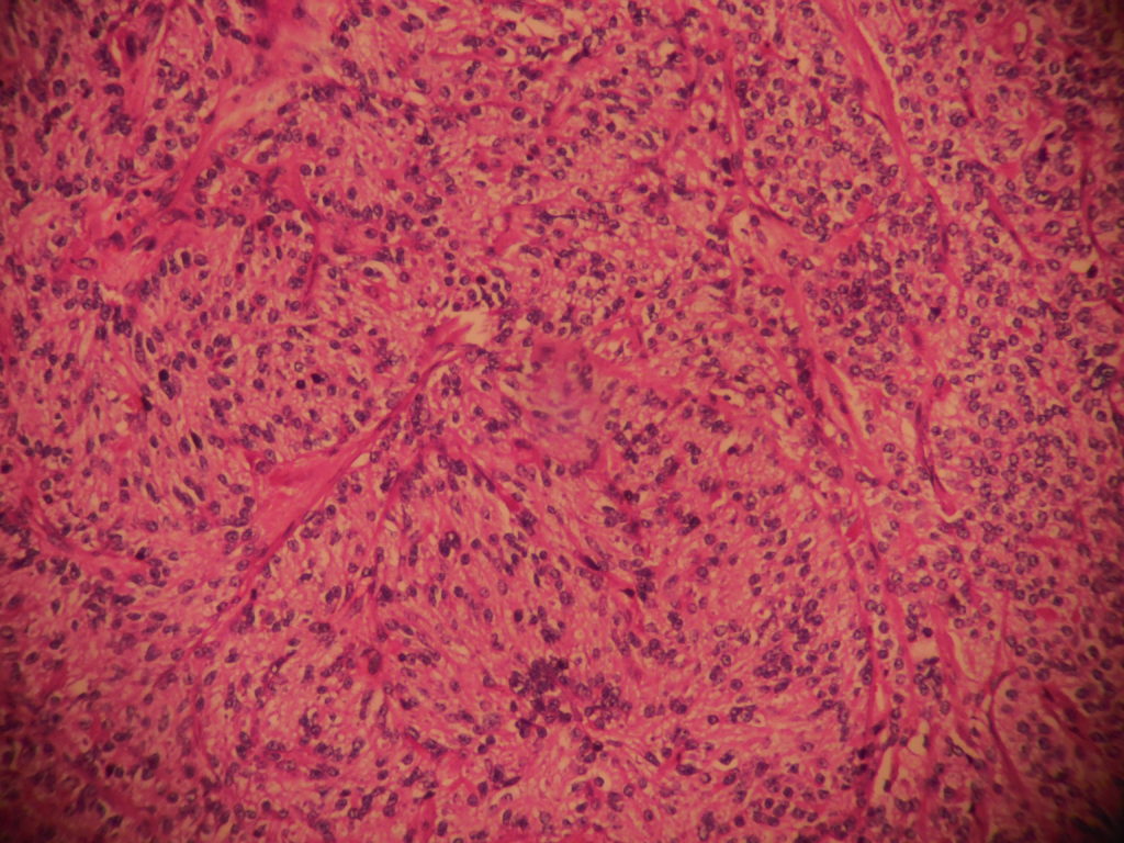 MEDULLARY CARCINOMA – THYROID – Histopathology.guru