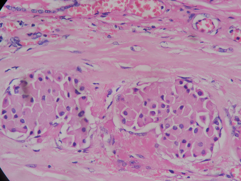 MEDULLARY CARCINOMA – THYROID – Histopathology.guru