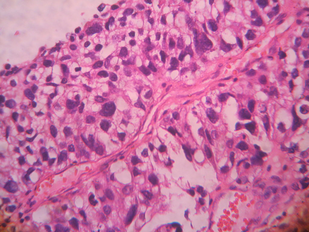 EPENDYMOMA – Histopathology.guru