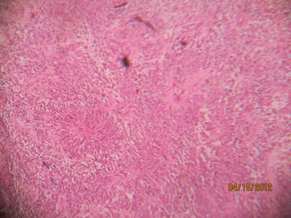 EPENDYMOMA – Histopathology.guru