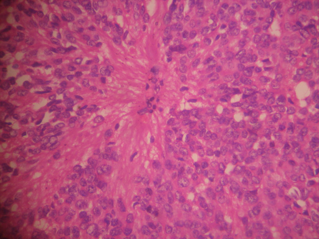 EPENDYMOMA – Histopathology.guru