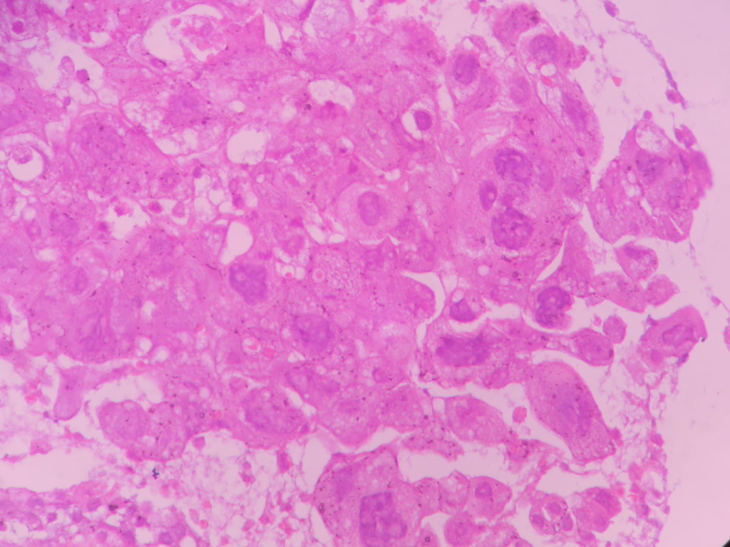 COMPLETE HYDATIDIFORM MOLE – Histopathology.guru