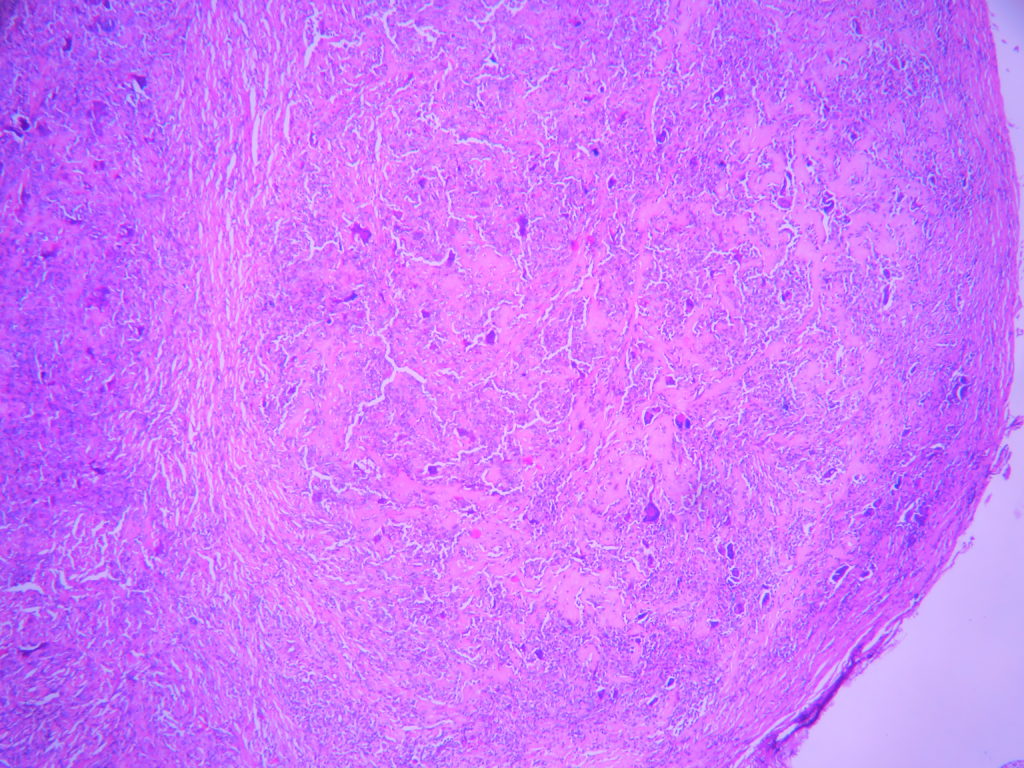 GIANT CELL TUMOR OF TENDON SHEATH – Histopathology.guru