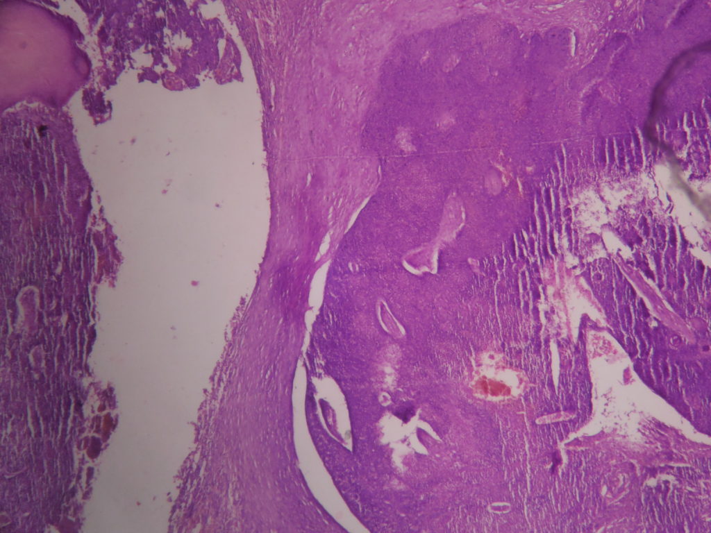 PILOMATRICOMA – Histopathology.guru