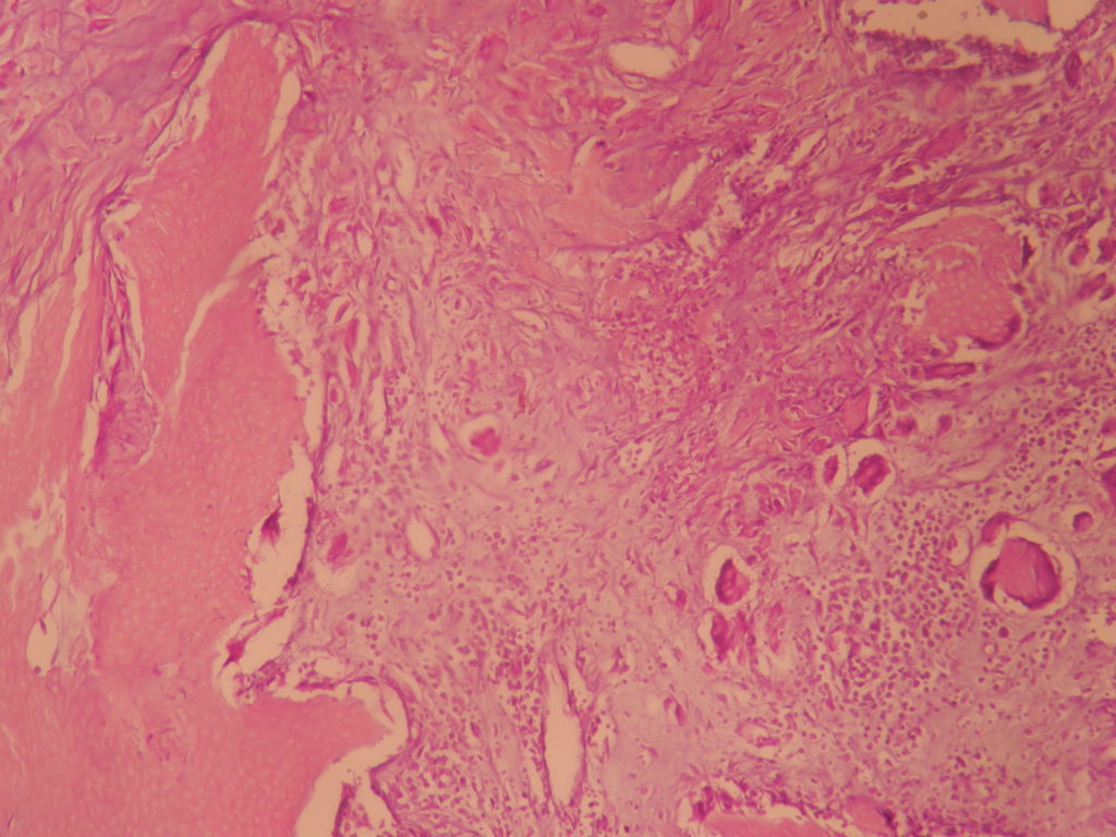 PILOMATRICOMA – Histopathology.guru